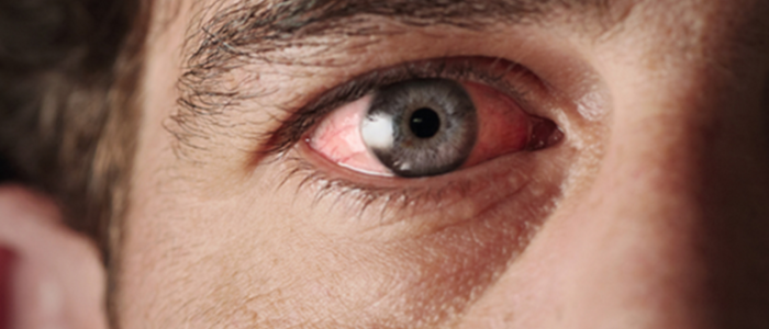 Medtech France - Traitement des infections de la cornée : un nouveau ...